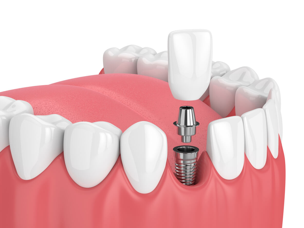 Dental Implants and Bone Loss | Rosewood Dental